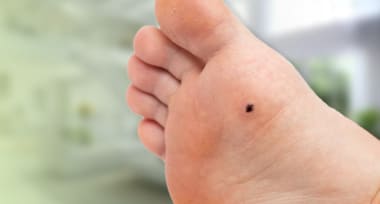 Astrological Meaning Of Moles On The Bottom Of The Feet | AstroVed.com